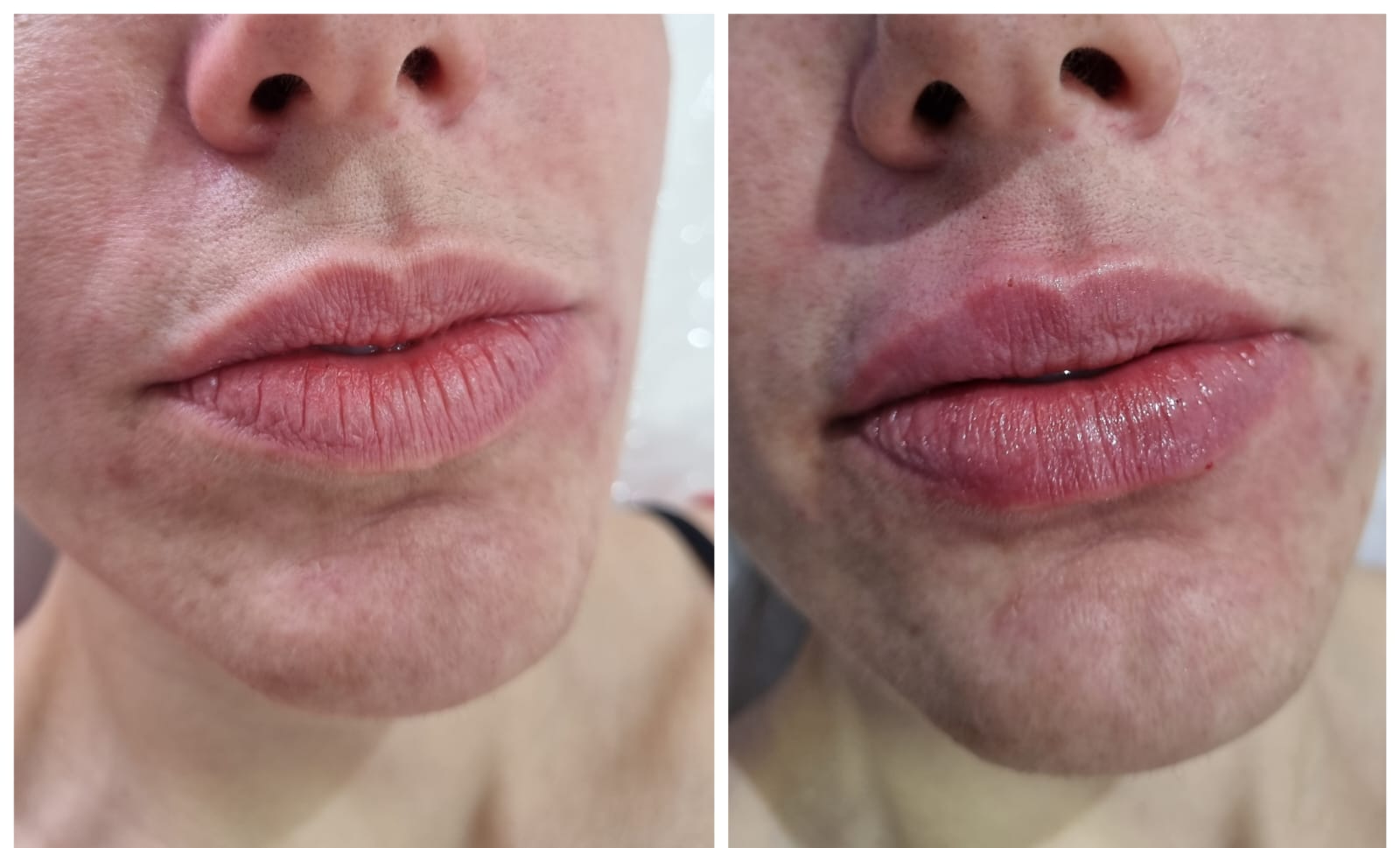 preenchimento labial - Clínica de Estetica e Depilação | Vai Laser